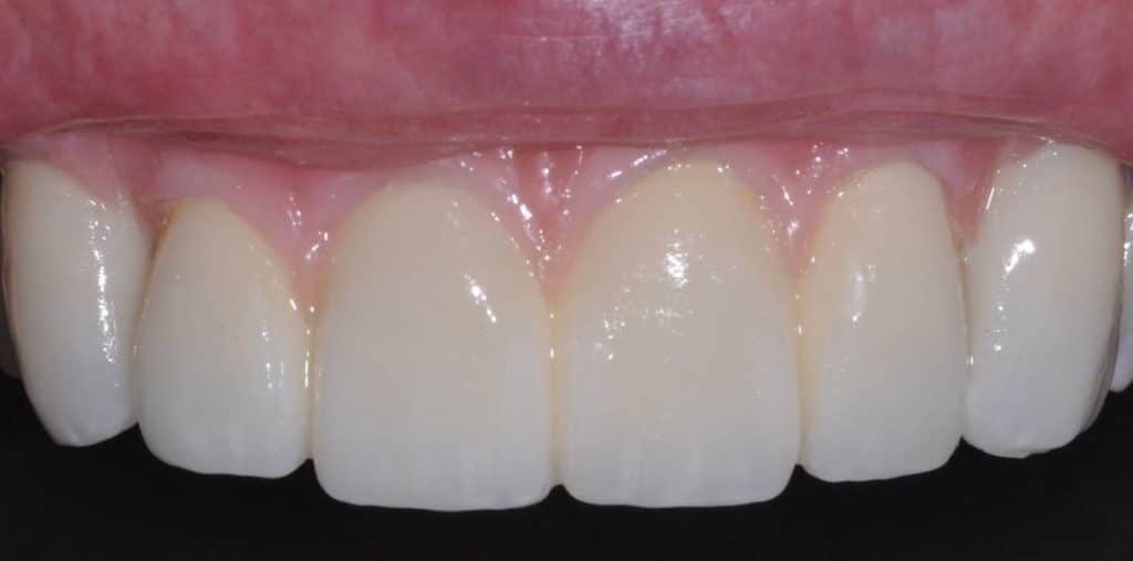 Dental Bridge | Dental Bridging Perth | West Coast Dental Care