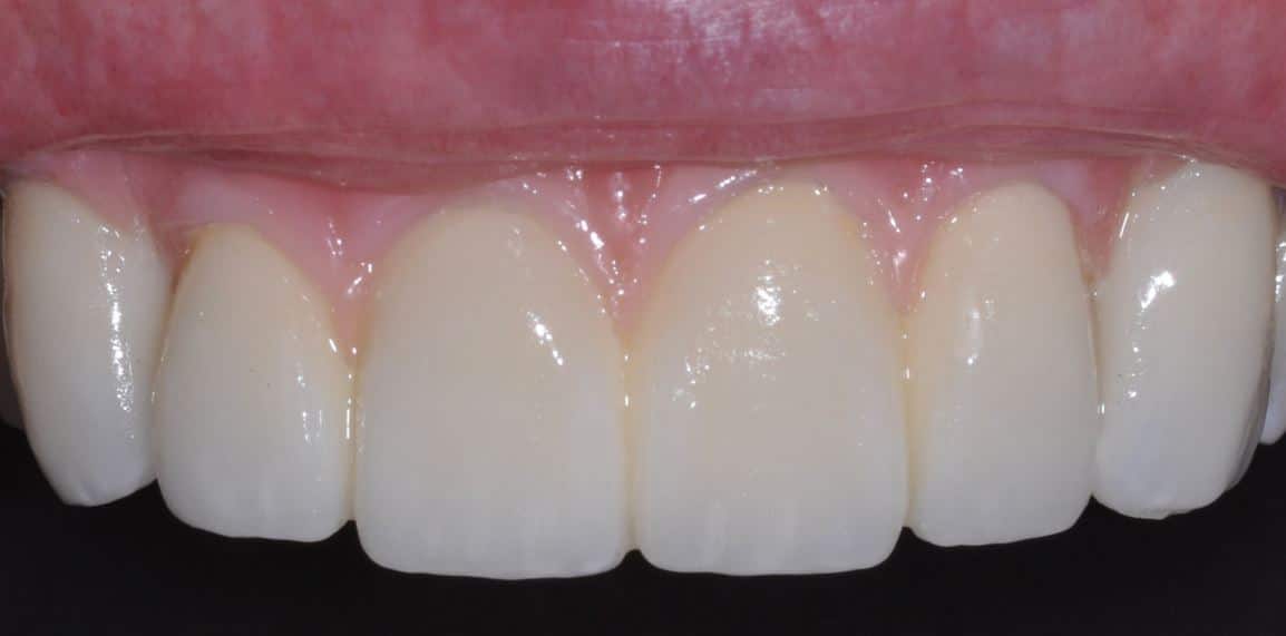 Dental Bridge | Dental Bridging Perth | West Coast Dental Care