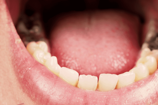 Sugar and Preventing Tooth Decay - West Coast Dental Care
